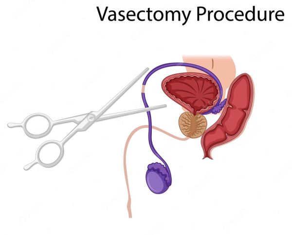 Vasectomy Procedure Patient Information Corner
