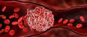 Blood Clots Overview: Recognizing the Warning Signs - Patient ...